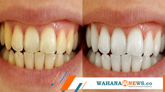 Bahannya Ada di Dapur, ini Cara Memutihkan Gigi Secara Alami - Wahana News