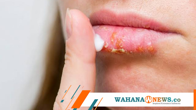 Berikut 6 Tips Cara Mudah Mengatasi Bibir Kering dan Pecah-pecah - Wahana News