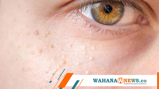 Waspada Xanthoma, Kelainan Kulit Akibat Kolesterol - Wahana News